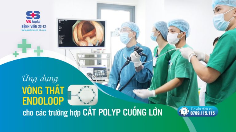 Ứng dụng vòng thắt endoloop cho các trường hợp cắt polyp cuống lớn